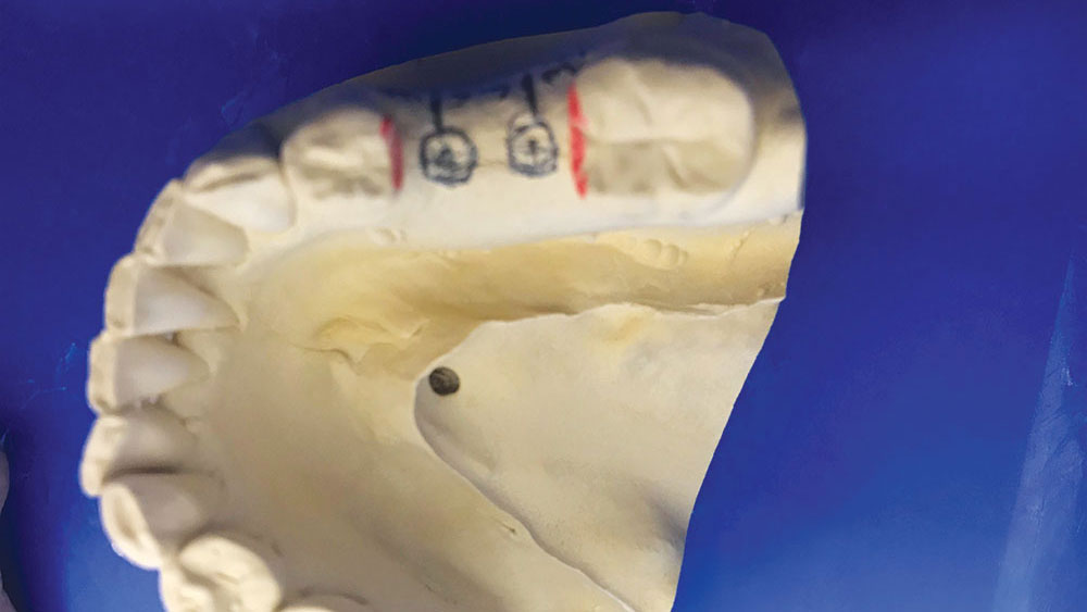 My First Glidewell HT™ Implant