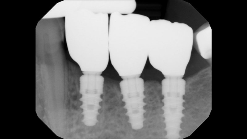 To Splint or Not to Splint: Two Approaches to Multi-Unit Implant ...