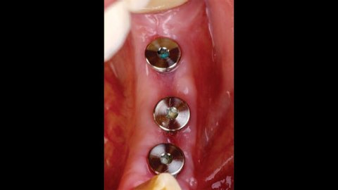 To Splint or Not to Splint: Two Approaches to Multi-Unit Implant ...
