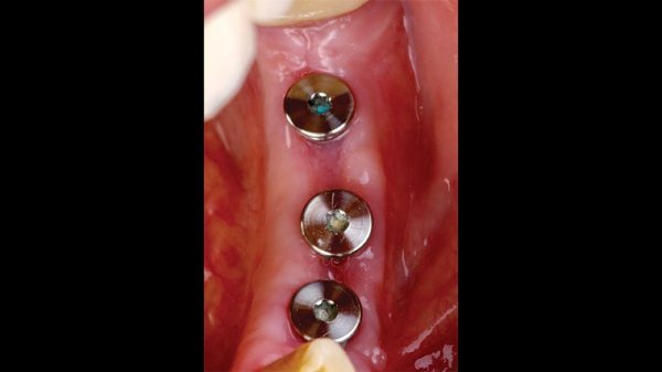To Splint or Not to Splint: Two Approaches to Multi-Unit Implant ...