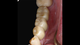 To Splint or Not to Splint: Two Approaches to Multi-Unit Implant ...