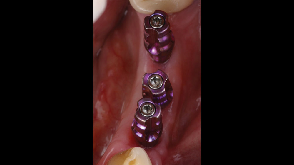 To Splint or Not to Splint: Two Approaches to Multi-Unit Implant ...