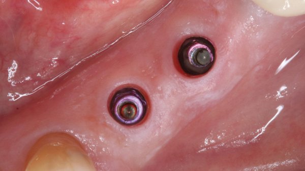 Product Spotlight: Penguin RFA® Determining Implant Stability with ...