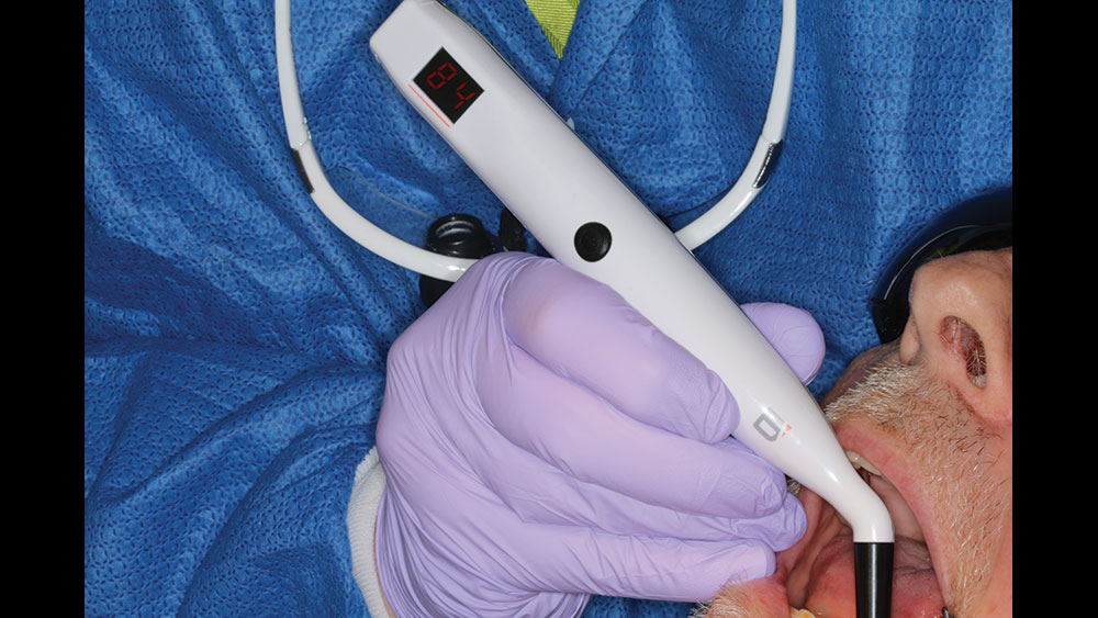 Product Spotlight: Penguin RFA® Determining Implant Stability with ...