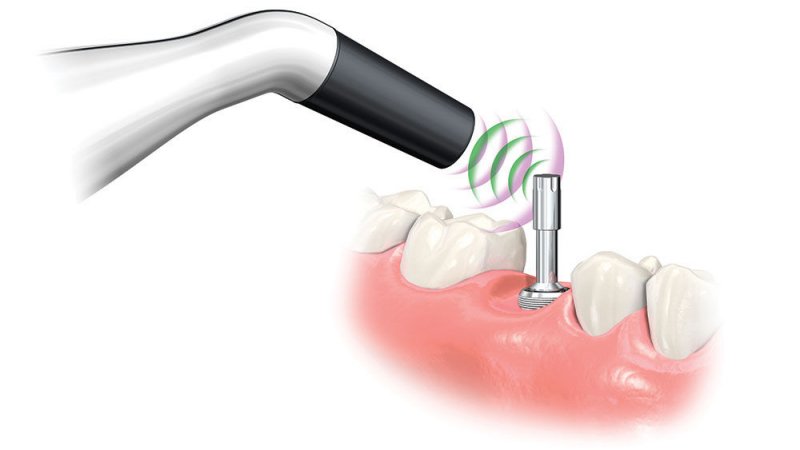 Product Spotlight: Penguin RFA® Determining Implant Stability with ...