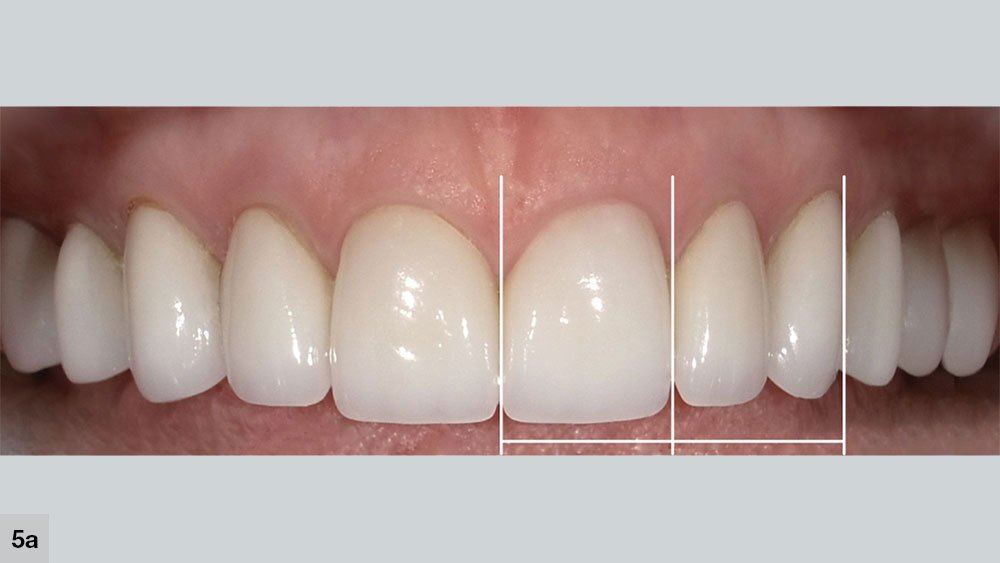 Cosmetic Dentistry: The Anatomy of a Natural Smile