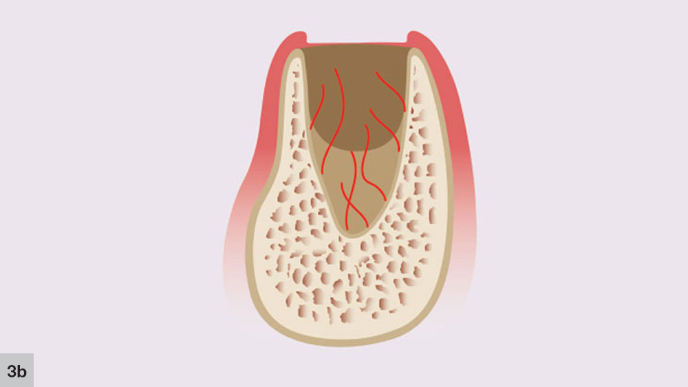 Extraction and Socket Grafting: Part 2 — Extraction Site Healing
