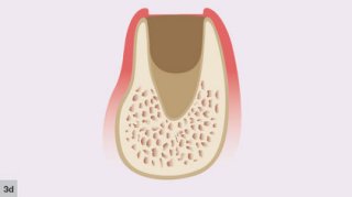 Extraction and Socket Grafting: Part 2 — Extraction Site Healing