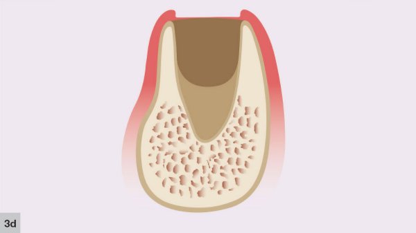Extraction and Socket Grafting: Part 2 — Extraction Site Healing