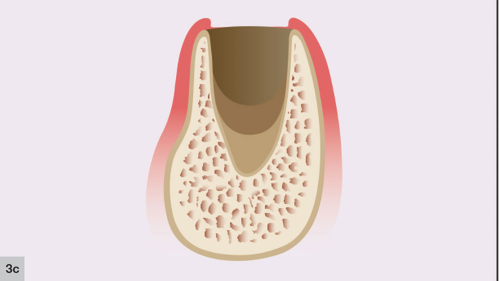 Extraction and Socket Grafting: Part 2 — Extraction Site Healing