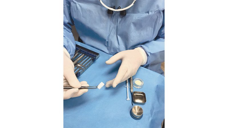 Extraction and Socket Grafting: Part 2 — Extraction Site Healing