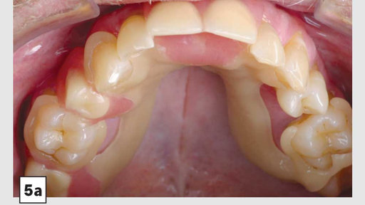 Milled Acetal Partial Dentures: A Clinical Case Report Exploring a New ...