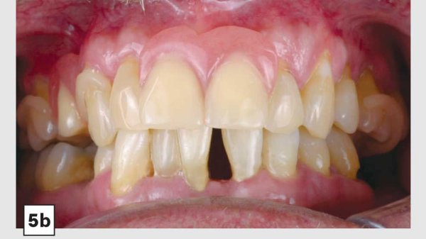 Milled Acetal Partial Dentures: A Clinical Case Report Exploring a New ...