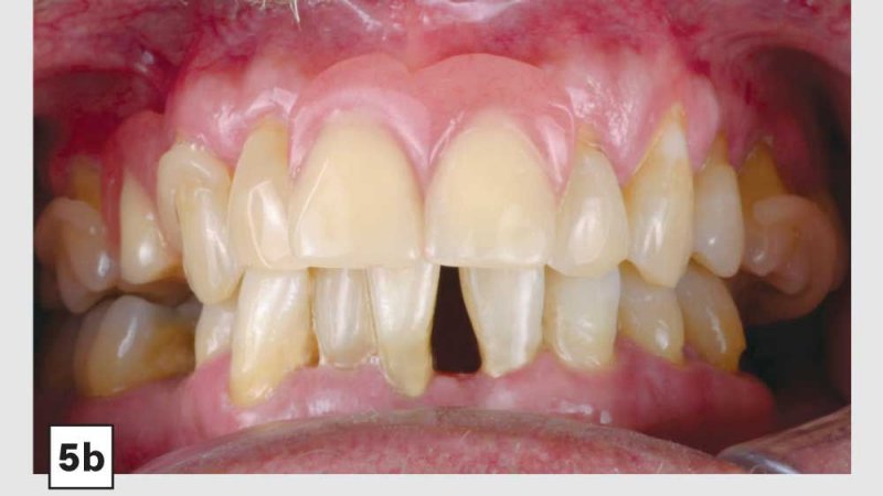 Milled Acetal Partial Dentures: A Clinical Case Report Exploring a New ...