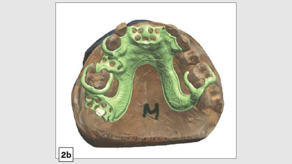 Milled Acetal Partial Dentures: A Clinical Case Report Exploring a New ...