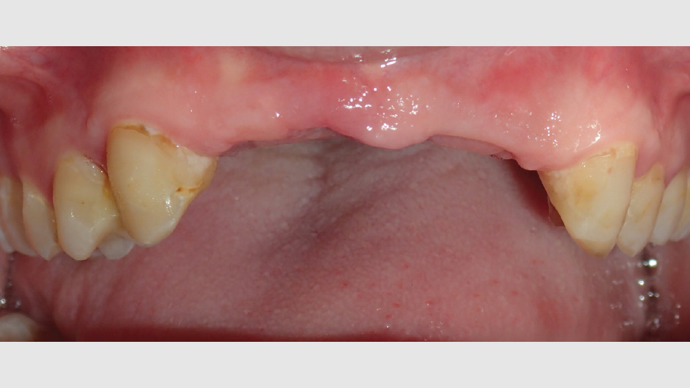 Lighting Up the Esthetic Zone