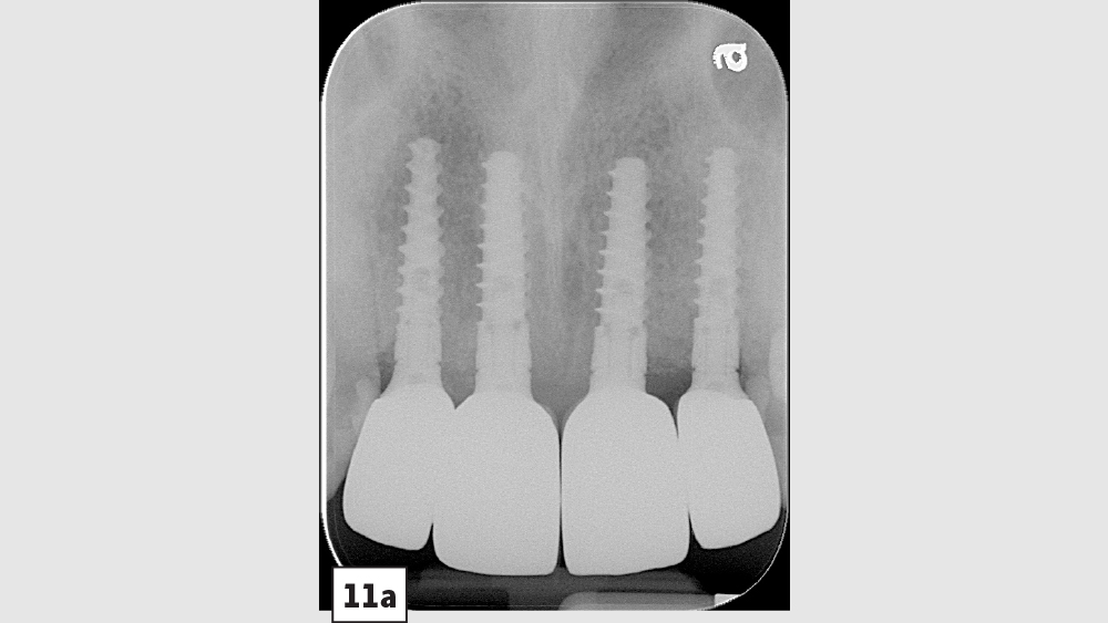 Lighting Up the Esthetic Zone