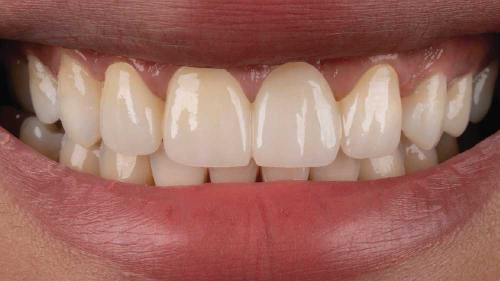 Restoring Long-Lost Smiles