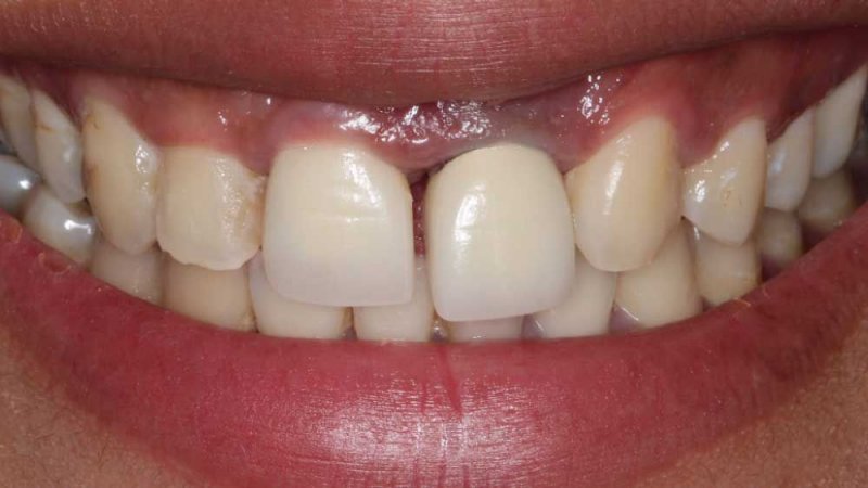 Restoring Long-Lost Smiles