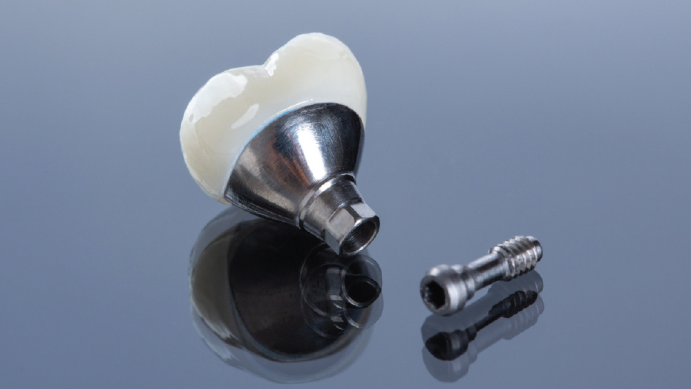 Screw- or Cement-Retained Implant Restoration — or Both?