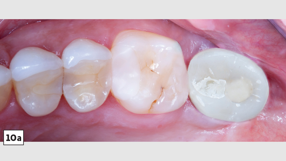 Screw- or Cement-Retained Implant Restoration — or Both?