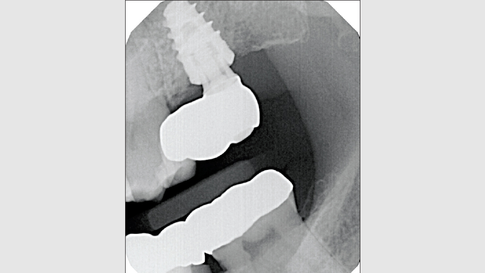 Screw- or Cement-Retained Implant Restoration — or Both?