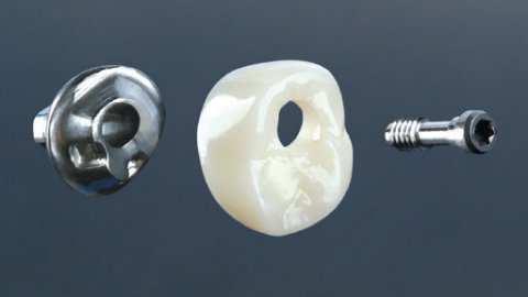 Screw- or Cement-Retained Implant Restoration — or Both?