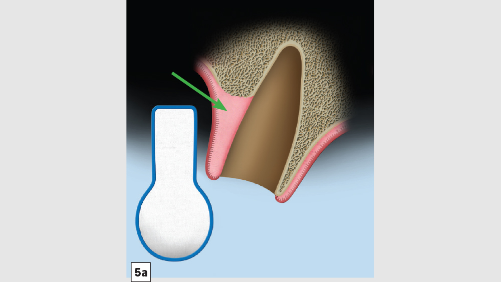Extraction and Socket Grafting: Part 3 — Socket Grafting Protocol