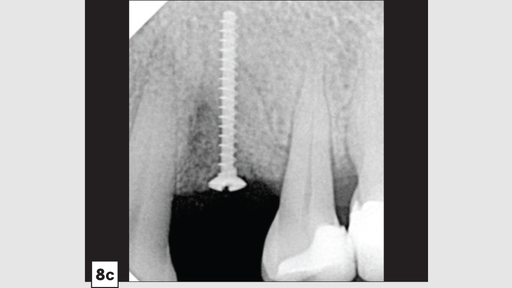 Extraction and Socket Grafting: Part 3 — Socket Grafting Protocol