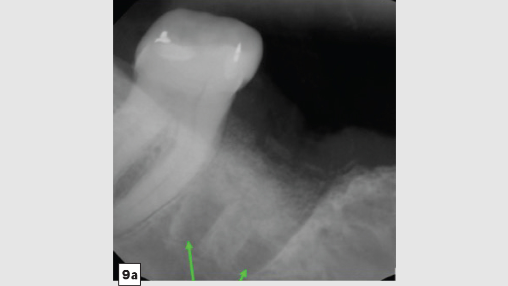 Extraction and Socket Grafting: Part 3 — Socket Grafting Protocol