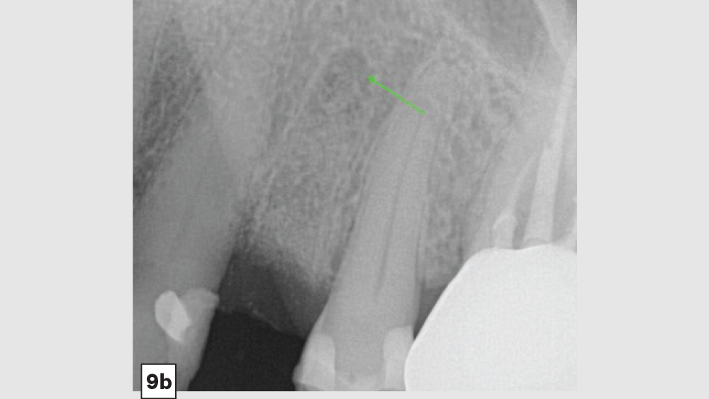 Extraction and Socket Grafting: Part 3 — Socket Grafting Protocol
