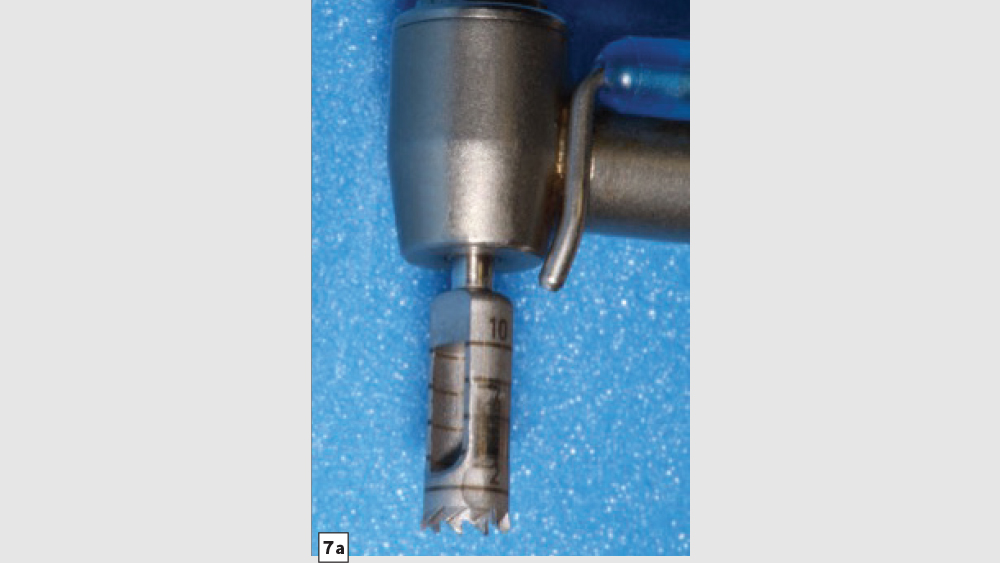 Extraction and Socket Grafting: Part 3 — Socket Grafting Protocol