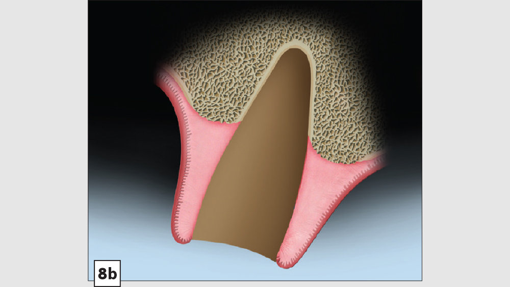 Extraction and Socket Grafting: Part 3 — Socket Grafting Protocol