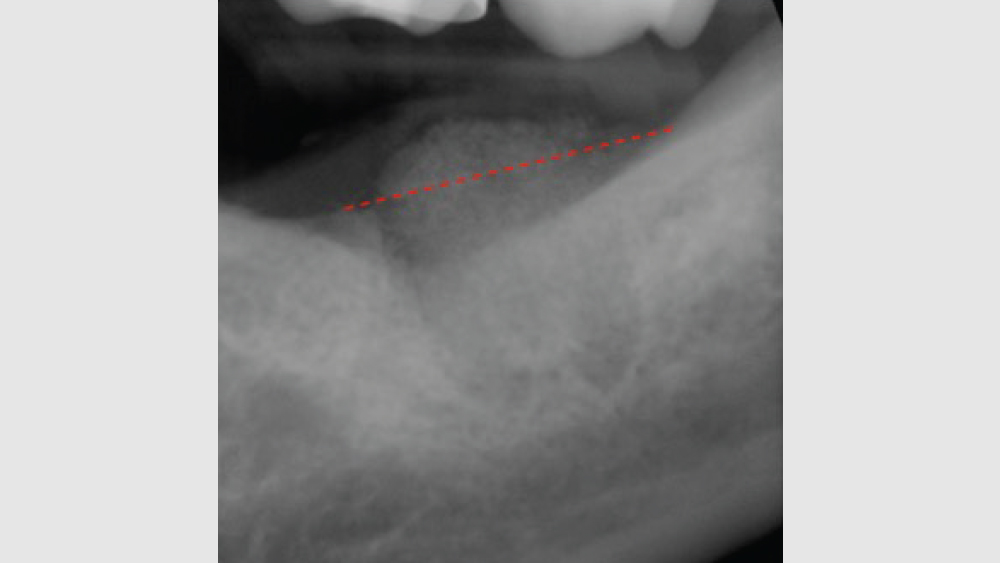 Extraction and Socket Grafting: Part 3 — Socket Grafting Protocol