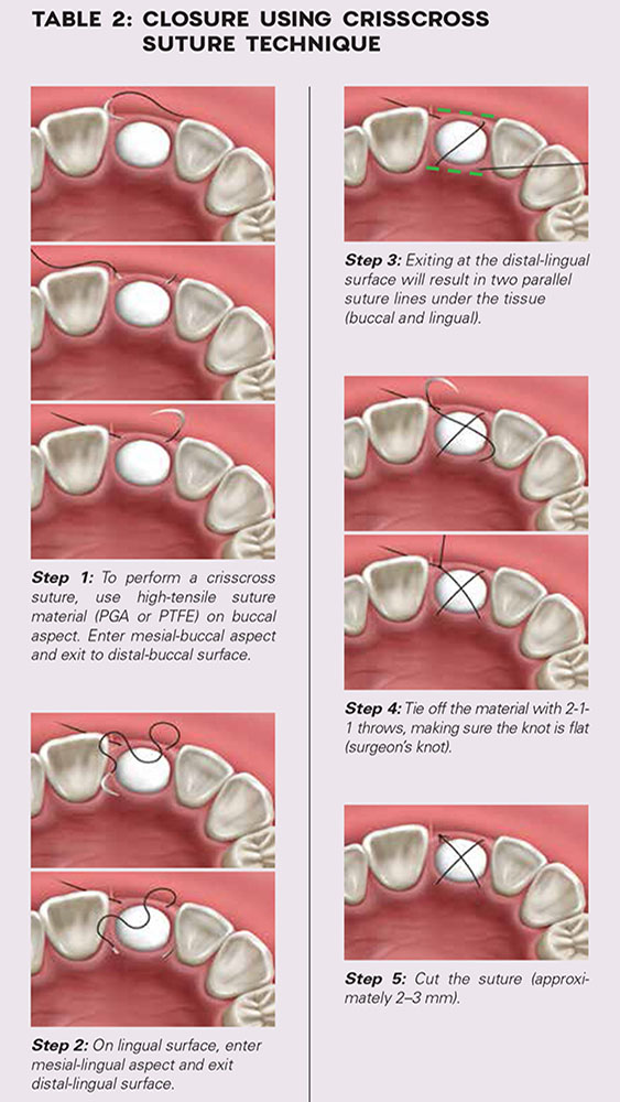 Extraction and Socket Grafting: Part 3 — Socket Grafting Protocol