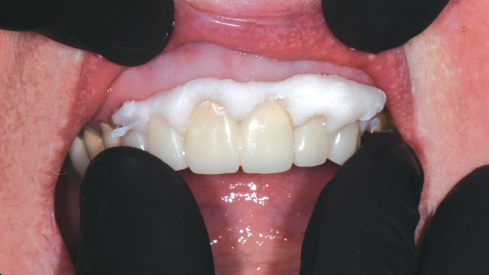 Using BioTemps Provisionals for Dental Case Acceptance