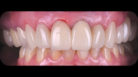 Using BioTemps Provisionals for Dental Case Acceptance