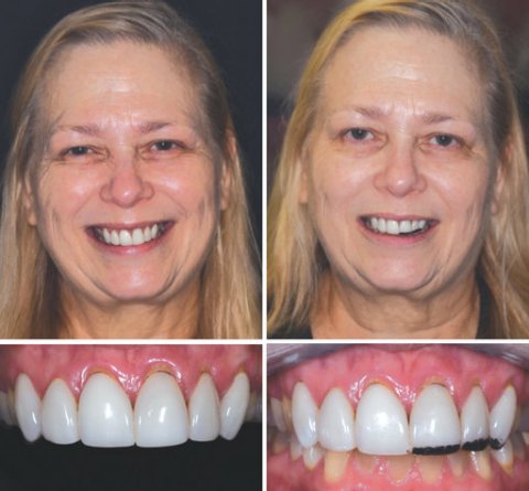 Using BioTemps Provisionals for Dental Case Acceptance