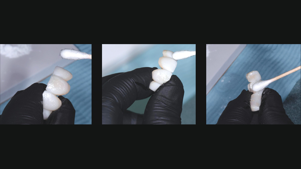 Using BioTemps Provisionals for Dental Case Acceptance