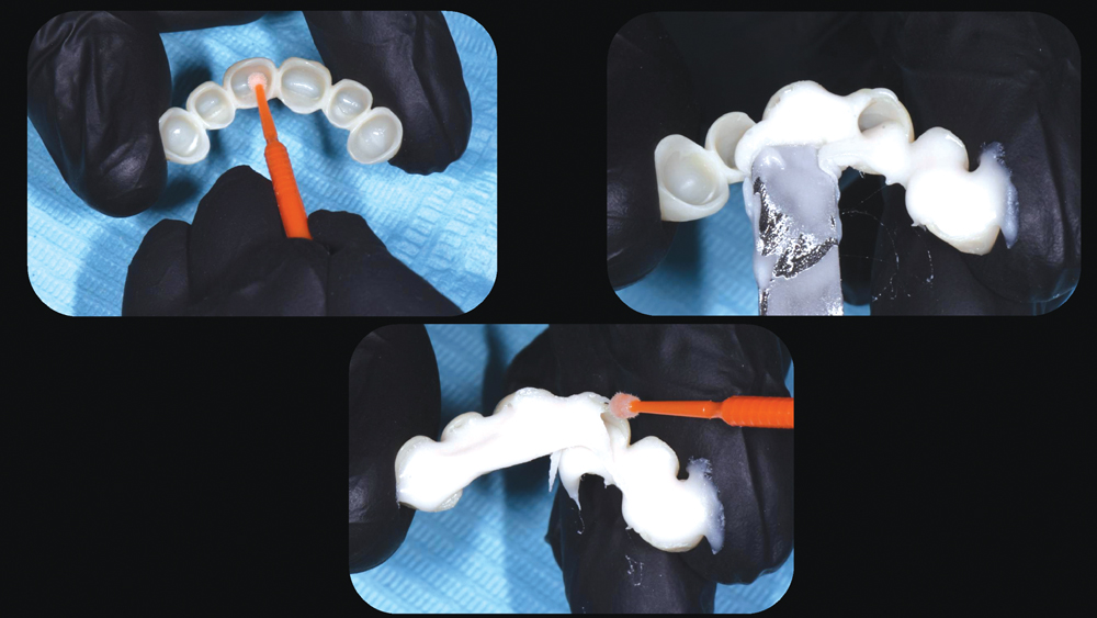 Using BioTemps Provisionals for Dental Case Acceptance