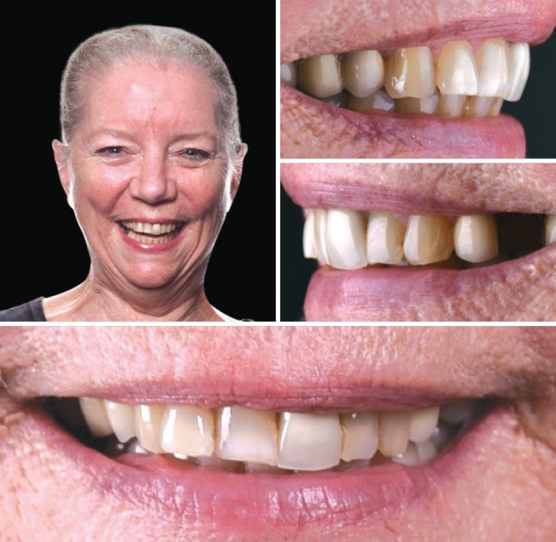 Using BioTemps Provisionals for Dental Case Acceptance