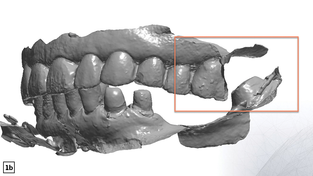 Digital Impressions: Common Problems and How to Avoid Them