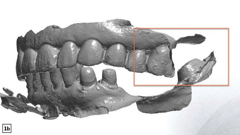 Digital Impressions: Common Problems and How to Avoid Them