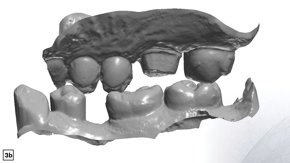 Digital Impressions: Common Problems and How to Avoid Them