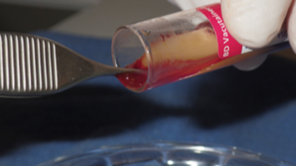 Enhancing Bone Regeneration | Chairside Dental Magazine