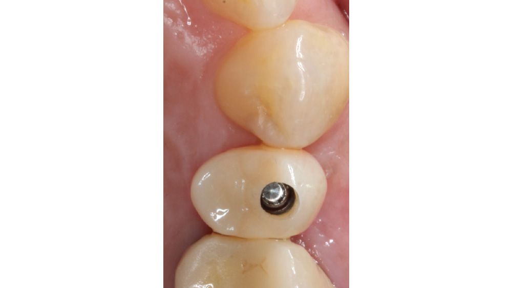 Flapless Dental Implant. When to Use a Flapless Technique?