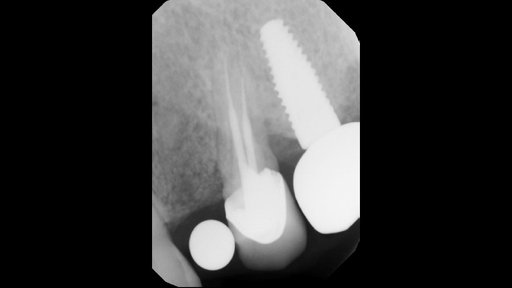 Flapless Dental Implant. When to Use a Flapless Technique?