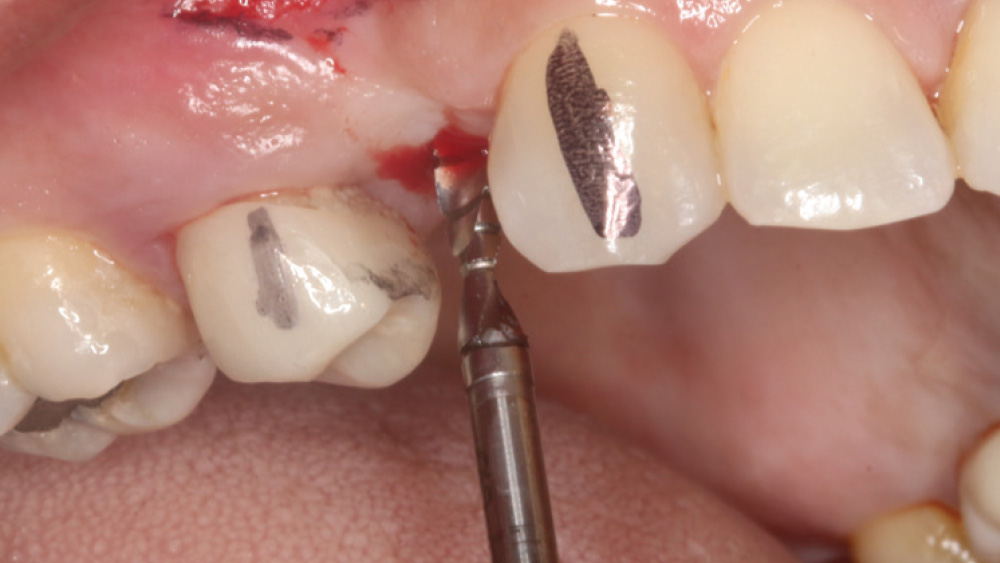 Flapless Dental Implant. When to Use a Flapless Technique?