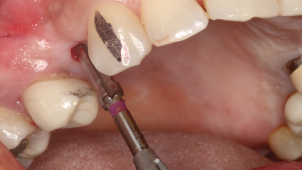 Flapless Dental Implant. When to Use a Flapless Technique?