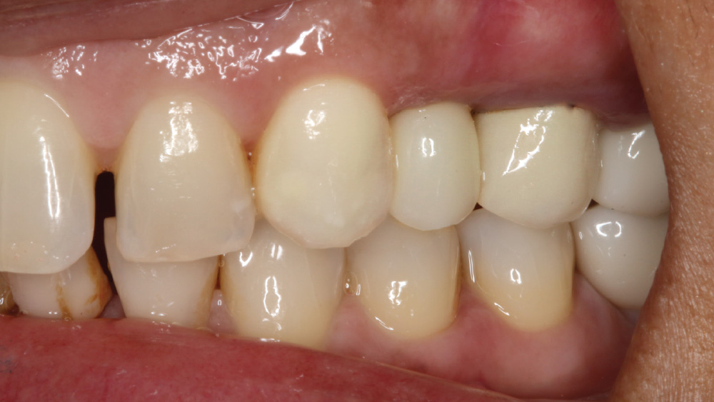 Flapless Dental Implant. When to Use a Flapless Technique?